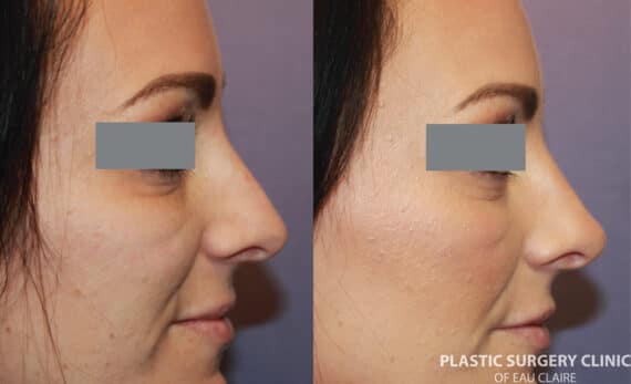 Liquid Rhinoplasty in Eau Claire, WI | Dr. Ember Ewings