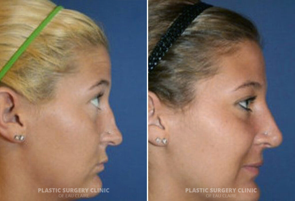 Essential Care Tips for Nosebleed Management Post-Rhinoplasty