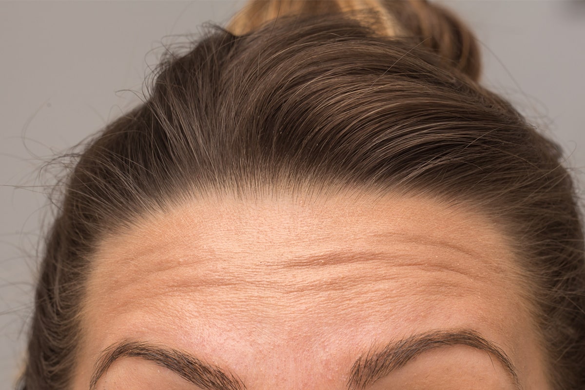 The Power of Botox Against Forehead Lines | Eau Claire